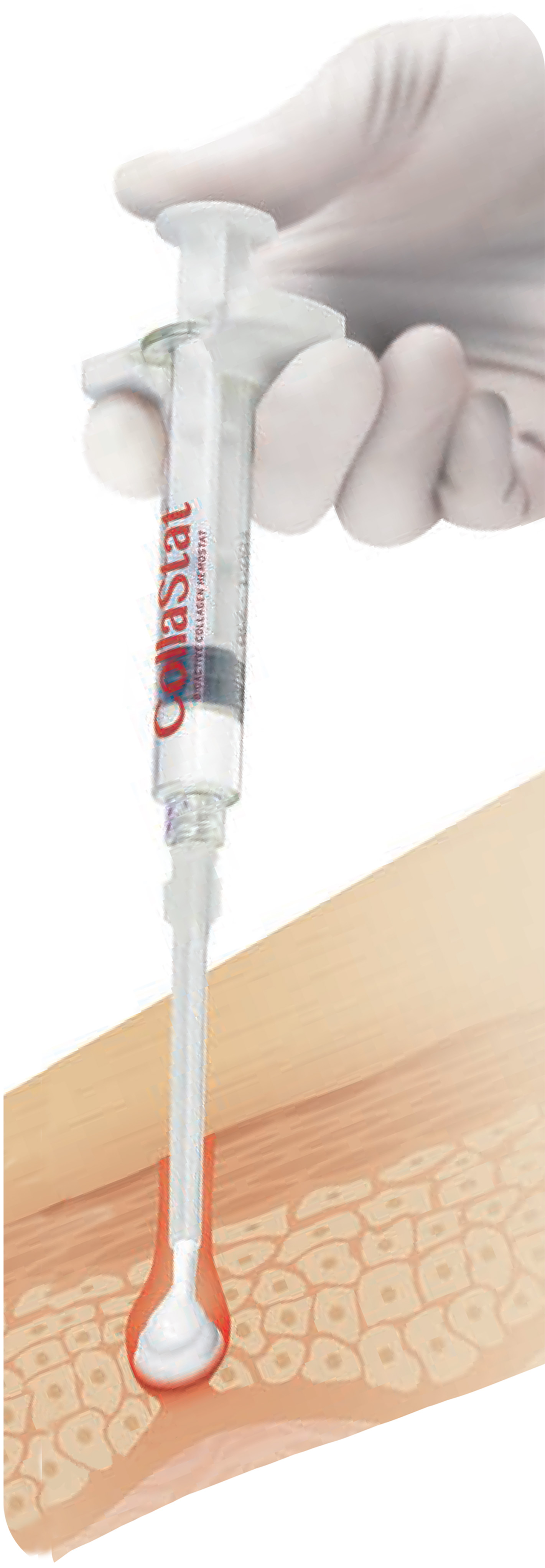 Advanced Flowable Haemostatic Product - Collastat - Delta Surgical